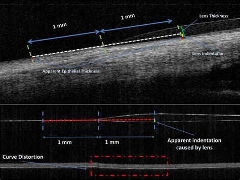Figure From Impact Of Soft Contact Lens Edge Design And Midperipheral Lens Shape On The