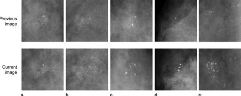 Computer Aided Diagnosis Scheme For Identifying Histological Classification Of Clustered