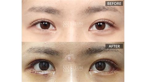 무보정전후영상 듀얼트임 뒤트임밑트임1주 Youtube