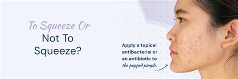 How To Pop A Pimple Correctly Without Leaving A Scar