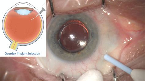 Ozurdex Implant Intravitreal Eye Injection For Treatment Of Retinal Oedema And Inflammation