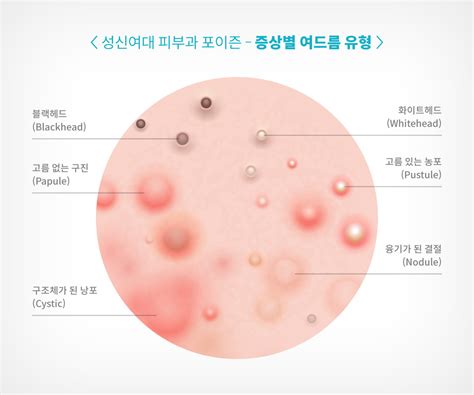 길음역피부과 여드름 치료는 진료부터 받아보시길 권유 드립니다 성신여대 포이즌 피부칼럼 성신여대피부과 포이즌의원