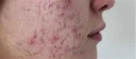 Красные пятна на лице: причины - Coolaser Clinic