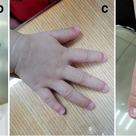 Facial Morphology Of The Presently Described Patient With The Crebbp Download Scientific