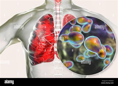 Pulmonary Cryptococcosis Invasion Of A Lung Tissue By Yeast Fungi Cryptococcus Neoformans With