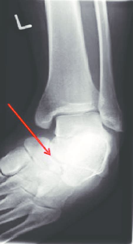 Anterioposterior Radiograph Of Left Foot Demonstrating Medial