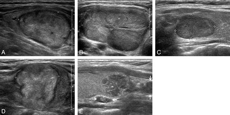 Radiology Thyroid Nodule Guidelines At Zoe Trout Blog