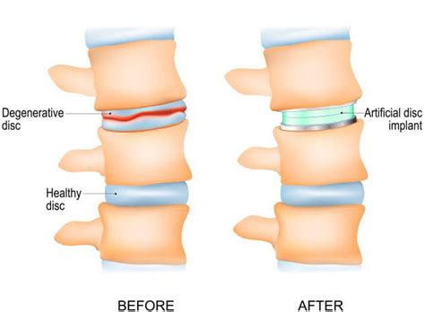 Is Cervical Disc Replacement An Option For You Legacy Health