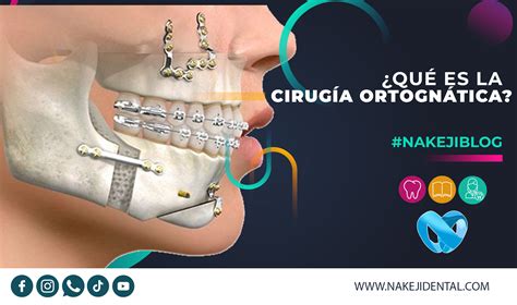 Blog What Is Orthognathic Surgery Nakeji Dental Clinic