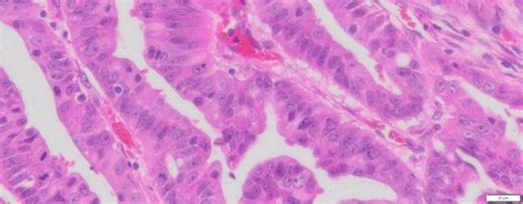 Human Pancreas Cancer Adenocarcinoma Ffpe Sections Human Pancreas Cancer Adenocarcinoma Ffpe Sections