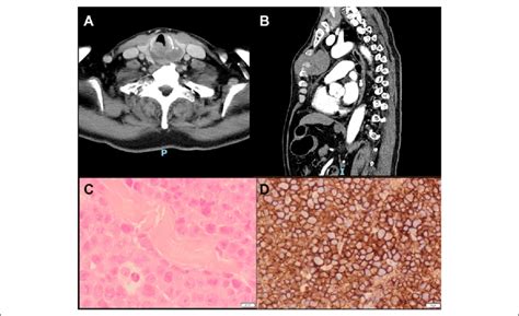 Computed Tomography Demonstrating A The Lesion In The Left Piriform Download Scientific