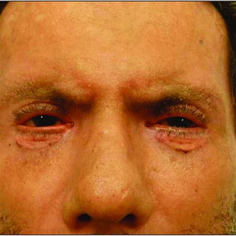 A 72 Year Old Man Presenting With Bilateral Lower Lid Ectropion Download Scientific Diagram