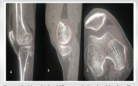 Figure 2 From Missed Medial Condyle Hoffa Fracture In A Case Of Lateral Condyle Hoffa Fracture