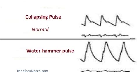 High Volume Pulse And Its Causes