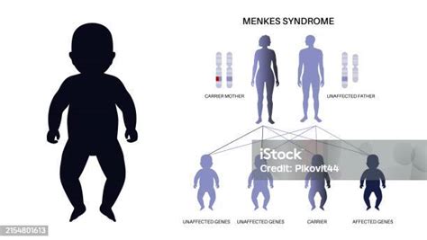 Menkes Syndrome Poster Stock Illustration Download Image Now Adult