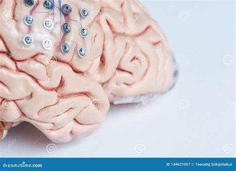 Subdural Grid Electrode For Brain Waves Recording On The Base Of Brain Stock Image