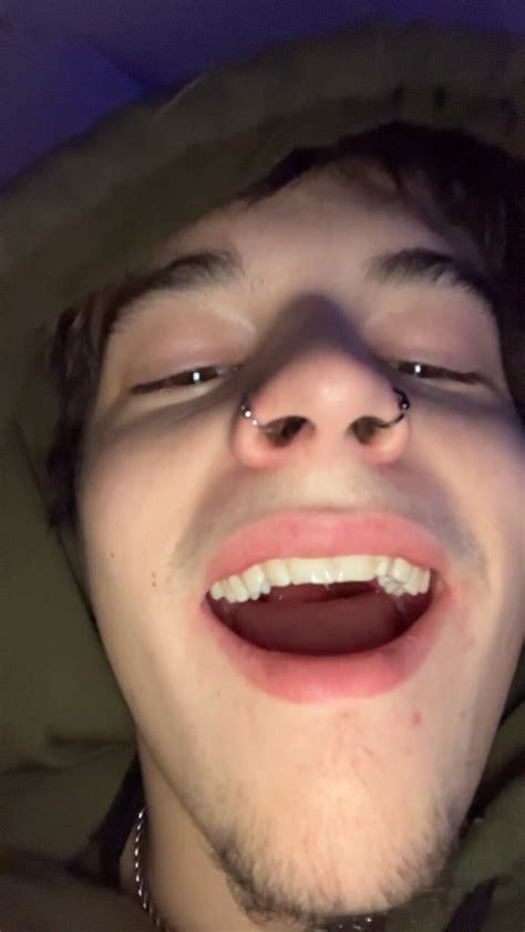 Swollen Uvula Em Inglês