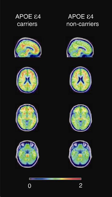 A β Deposition In Apoe ε 4 Carriers And Non Carriers Download Scientific Diagram