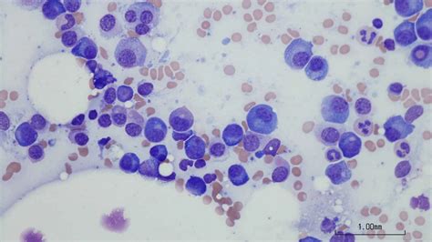 Malignant Neoplasm Definition And Treatment Alpine Biomedical