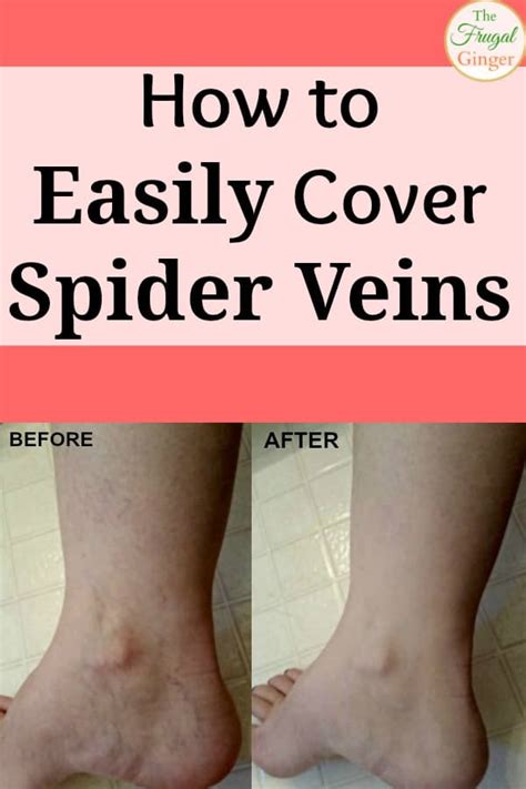 How To Easily Cover Spider Veins