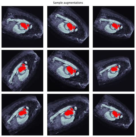 Github Singhankit1010 Atrium Segmentation