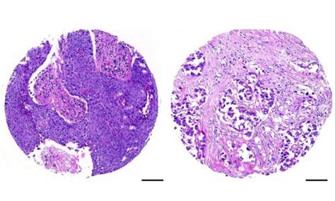 An Exciting New Era For Tissue Microarrays • Healthcare In