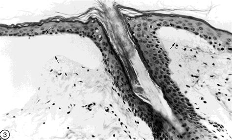 Lm Of A 02 Mgml Of Hd Treated Ippsf Depicting Epidermal Dermal