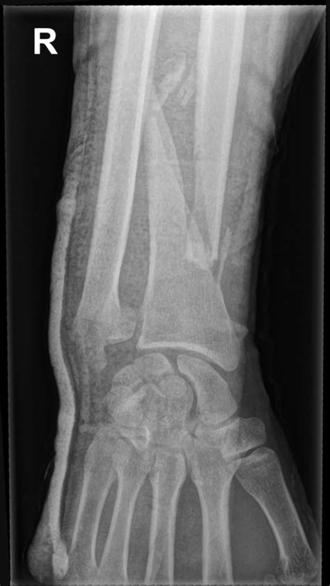 Before And After Surgery R Radiology