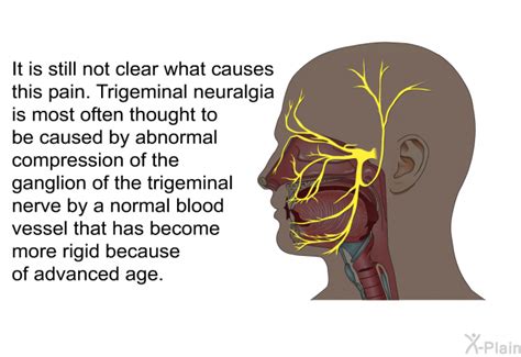 PatEdu Com Trigeminal Neuralgia