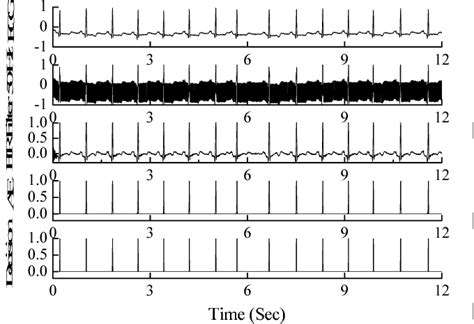 Figure 4 From Efficient Qrs Detection In Wearable Ecg Devices For Body Sensor Network Semantic