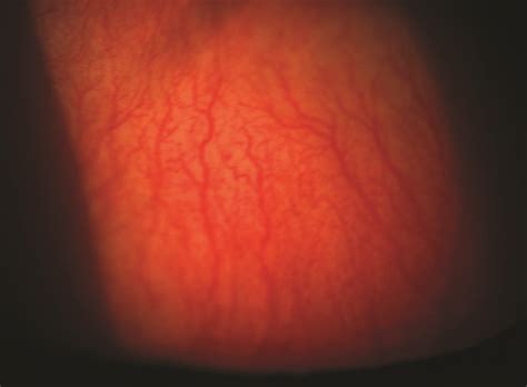 Case Report On Keratoconus At Charles Macias Blog