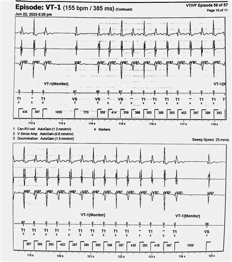Kashif Chaudhry On Twitter 60f With Ischemic Cmp And A Single Chamber Icd Having Episodes Of