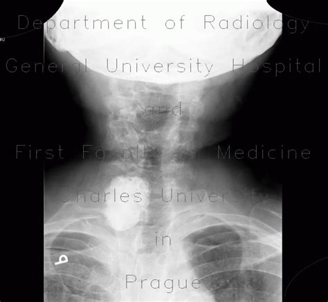 Radiology Case Calcification In Goiter Thyroid Gland