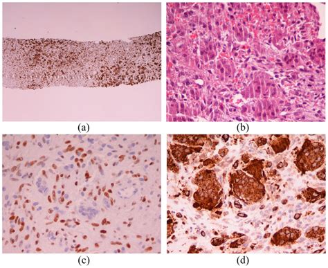 Cd68 Immunostaining Was Performed 20× Using This Marking For Giant Download Scientific