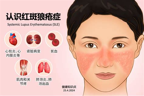 红斑狼疮是一种自体免疫疾病，没有药物可以治疗。 今晚一起来认识 Lilys Amazing World Facebook