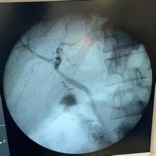 Intraoperative Cholangiography Image Download Scientific Diagram