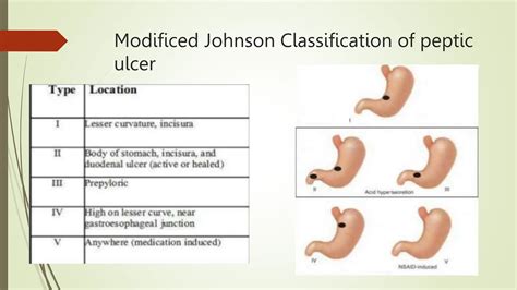 Perforated Peptic Ulcer Pptxuyfufhgdssgshdh Pptx Digestive