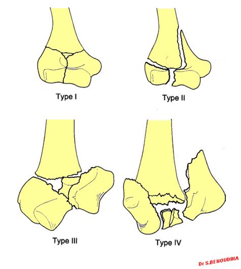 Classification Of Distal Humerus Fracture At David Prather Blog Classification Of Distal Humerus Fracture At David Prather Blog