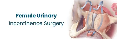 Female Urinary Incontinence Surgery Options And What To Know