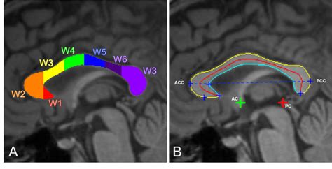 Automatically Defined Boundaries Of The Corpus Callosum A Download Scientific Diagram