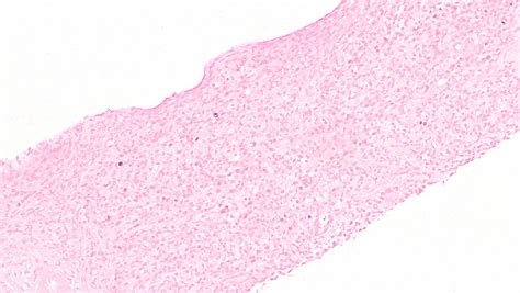 Pathology Outlines Hhv8 Related Dlbcl Nos