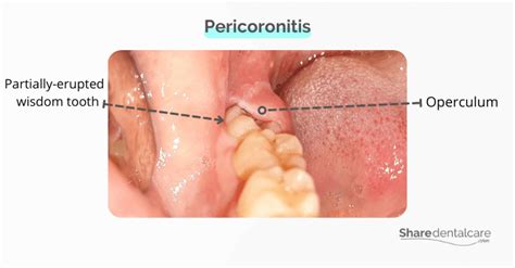 Swollen Gums Around Wisdom Tooth Guide To Pericoronitis Relief Share Dental Care