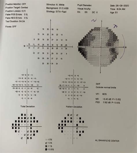 The Central 24 2 Humphrey Visual Field Test Of The Right Eye Showed Download Scientific