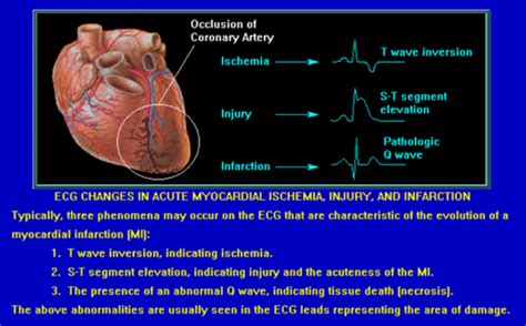 Ischemia Vs Infarction Ecg