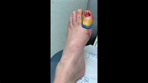 Total Matrixectomy Youtube