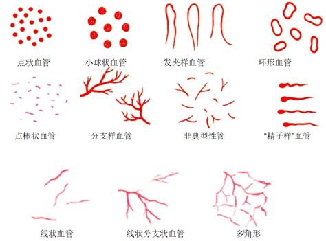 多图预警皮肤镜下不同血管形态都提示什么皮肤病 MedSci cn