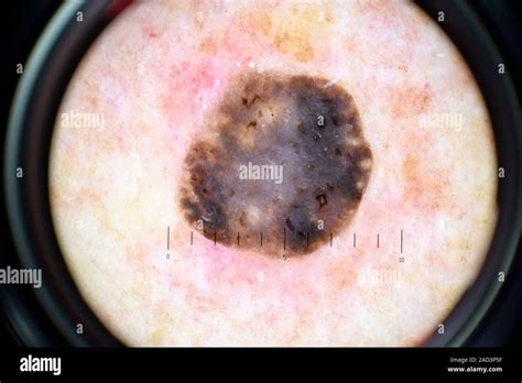 Seborrheic Keratosis Dermatoscope Image Of A Seborrheic Keratosis