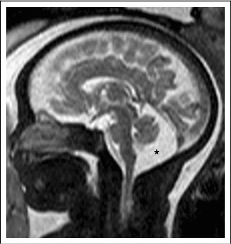 Figure 1 From The Fetal Cerebellum Semantic Scholar