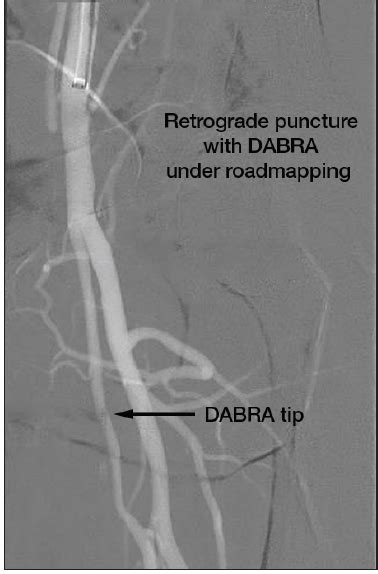 Case Report Retrograde Laser Crossing Of A Left Sfa Occlusion With An Ambiguous Proximal Cap