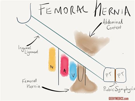 Anatomy Of Inguinal Hernia Inguinal Hernia Anatomy Uzli